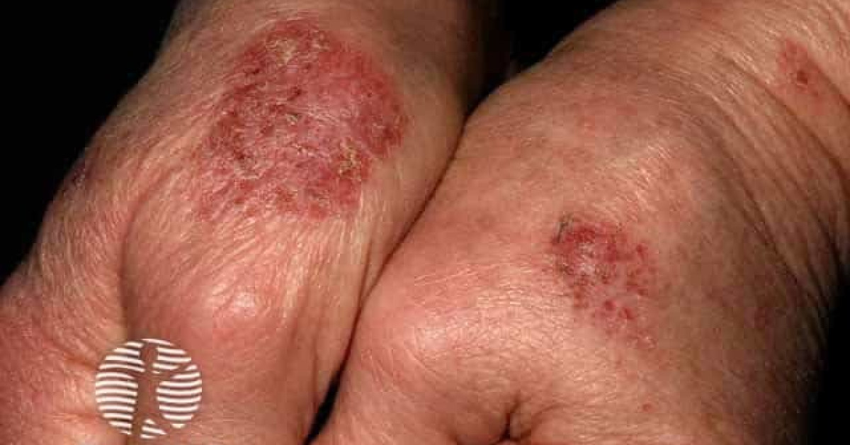 Nummular dermatitis discoid eczema image