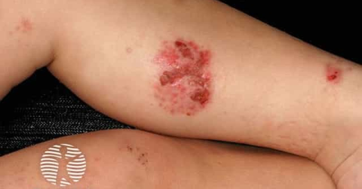 Nummular dermatitis discoid eczema image