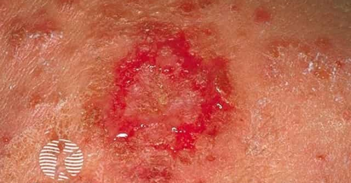 Nummular dermatitis discoid eczema image