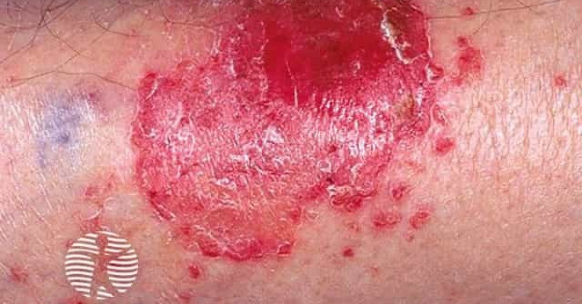 Nummular dermatitis discoid eczema image