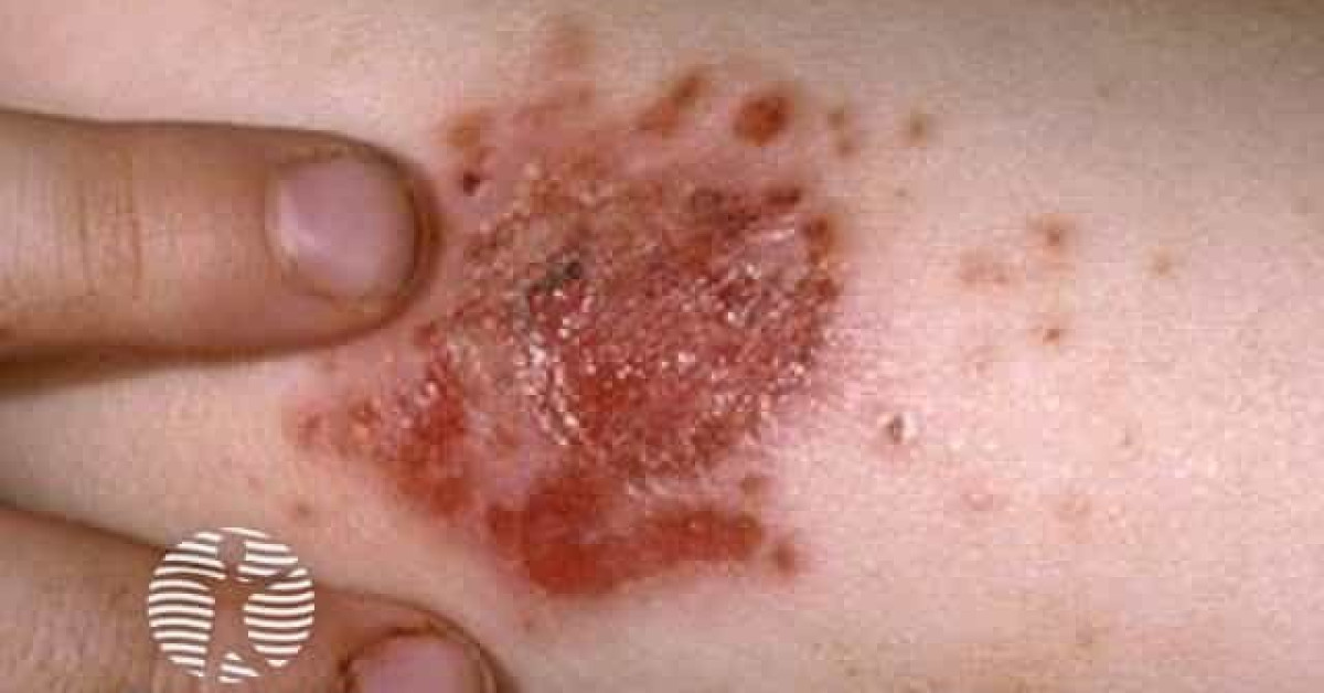 Nummular dermatitis discoid eczema image