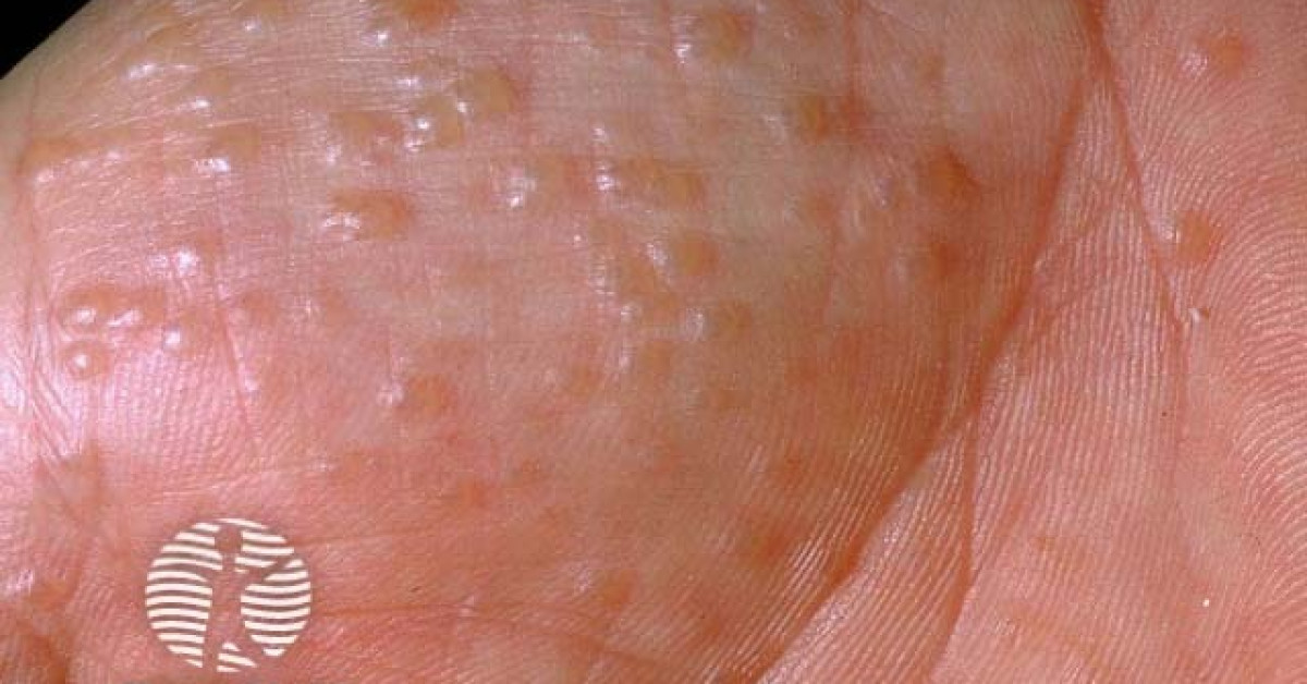 DermNet® - Pompholyx image