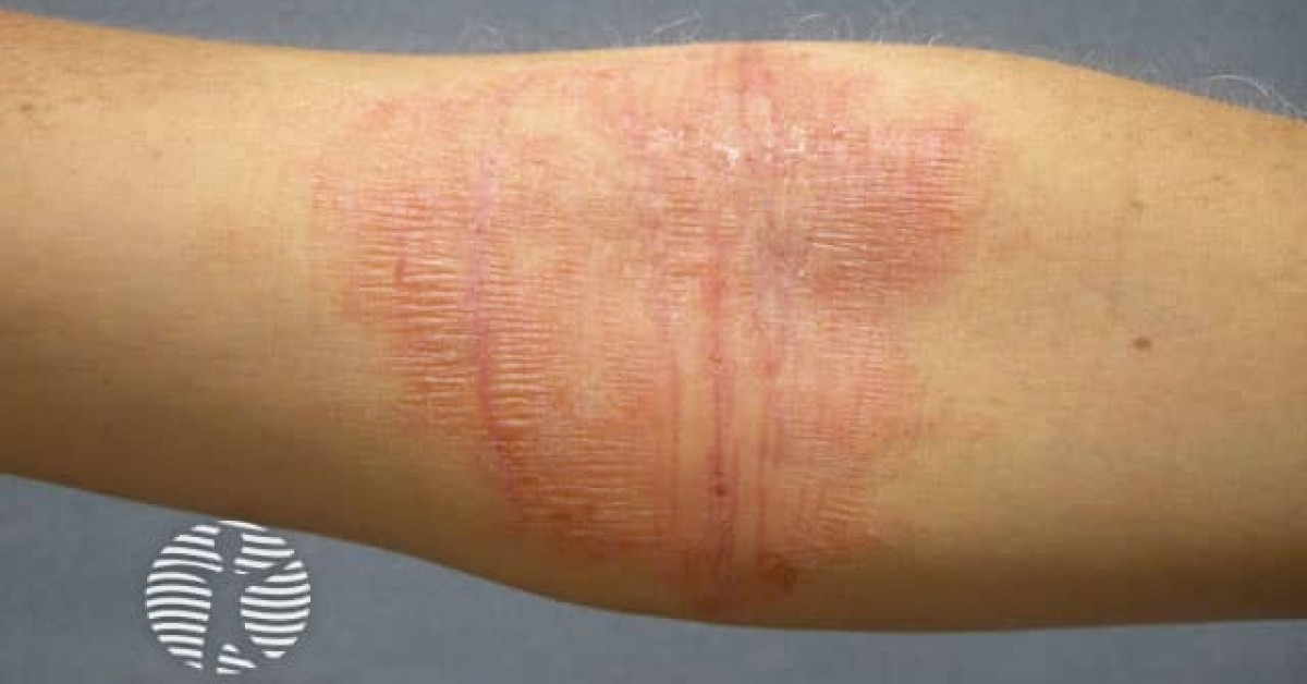 Atopic dermatitis image