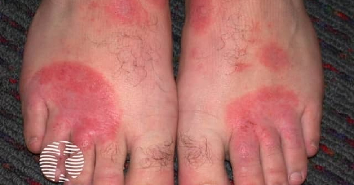Shoe dermatitis image