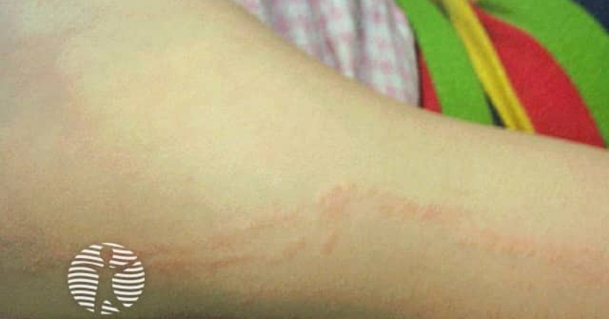 Lichen striatus image