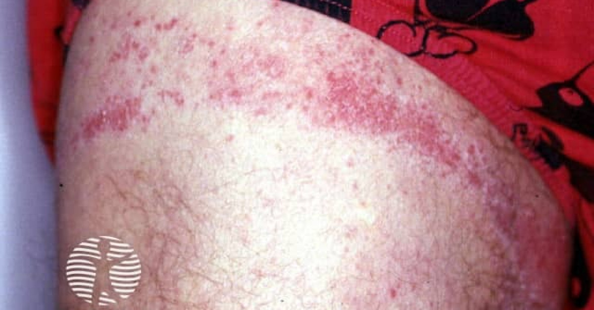 Rubber dermatitis image