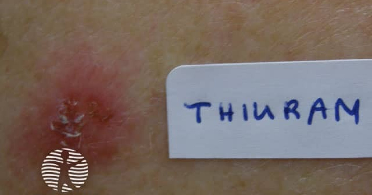Patch test positive to thiuram image