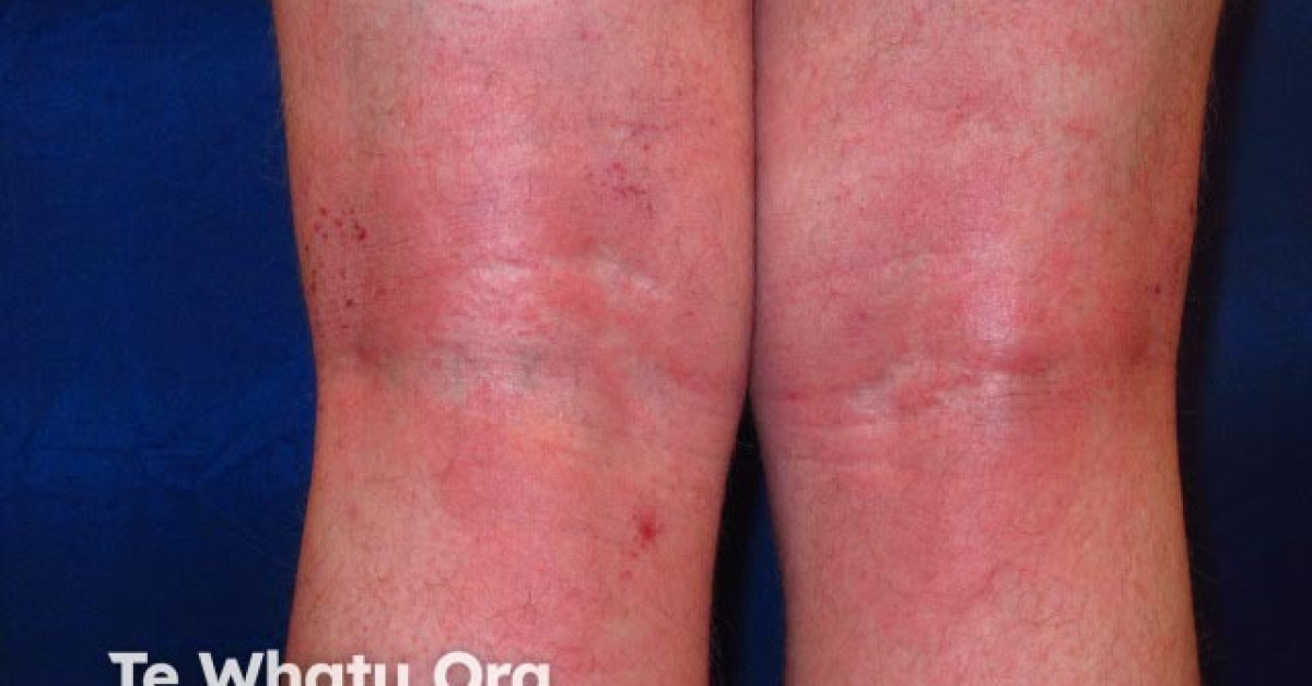 Flexural eczema image