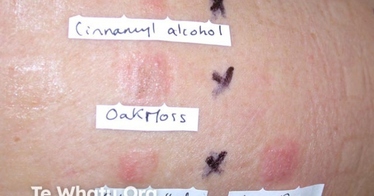 Patch tests in cosmetic allergy image