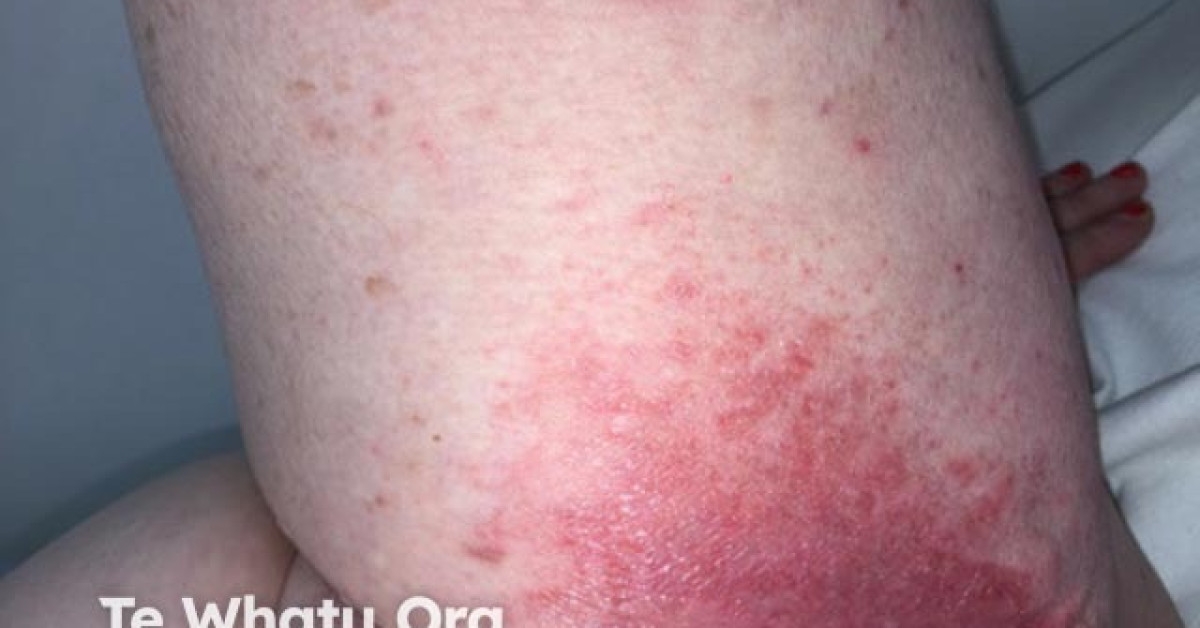 Contact irritant dermatitis due to urine. Napkin dermatitis in adult. image