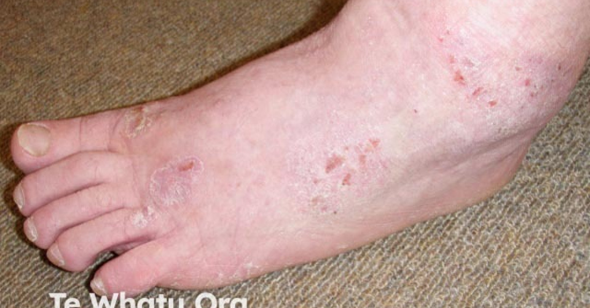 Shoe dermatitis image