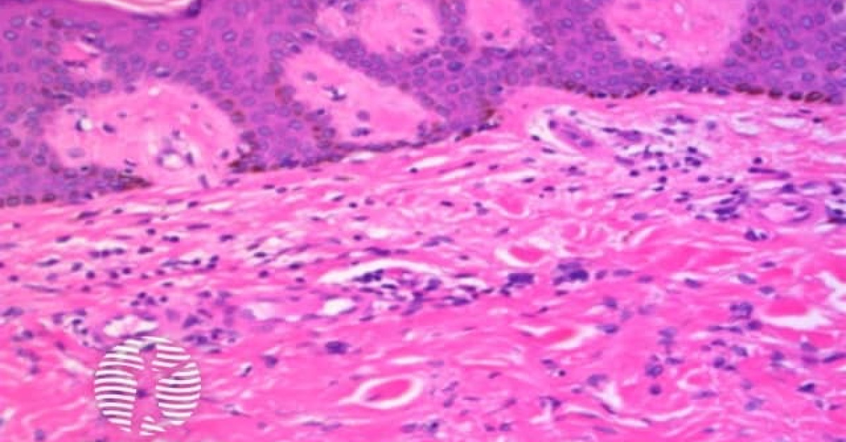 Dermatofibroma pathology image