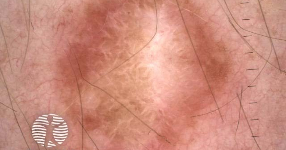 Dermatofibroma dermoscopy image