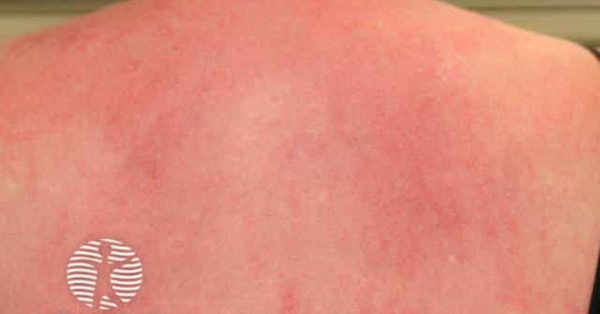 Dermatomyositis image