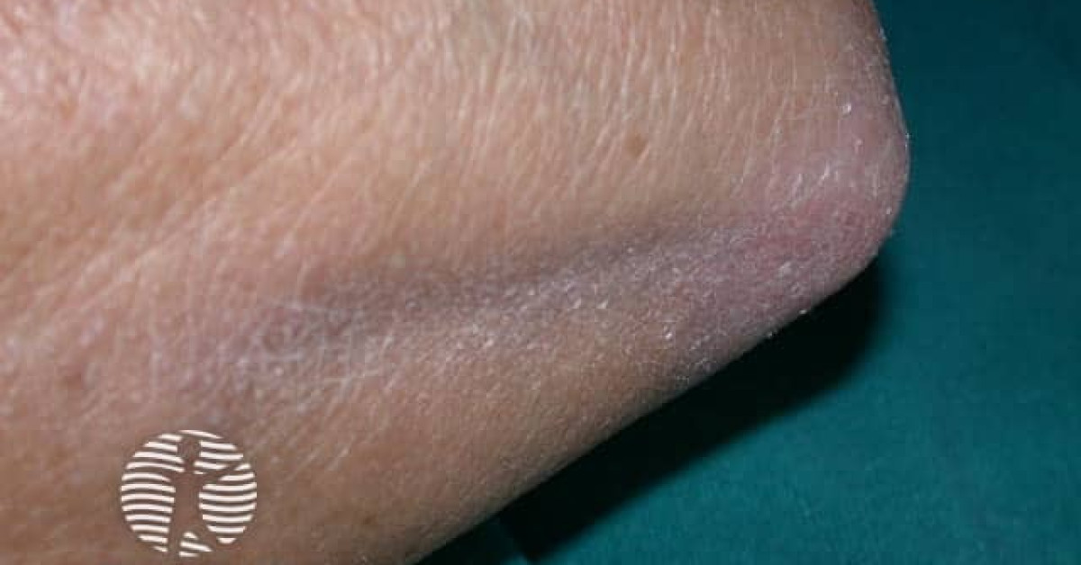 Dermatomyositis of the arm image