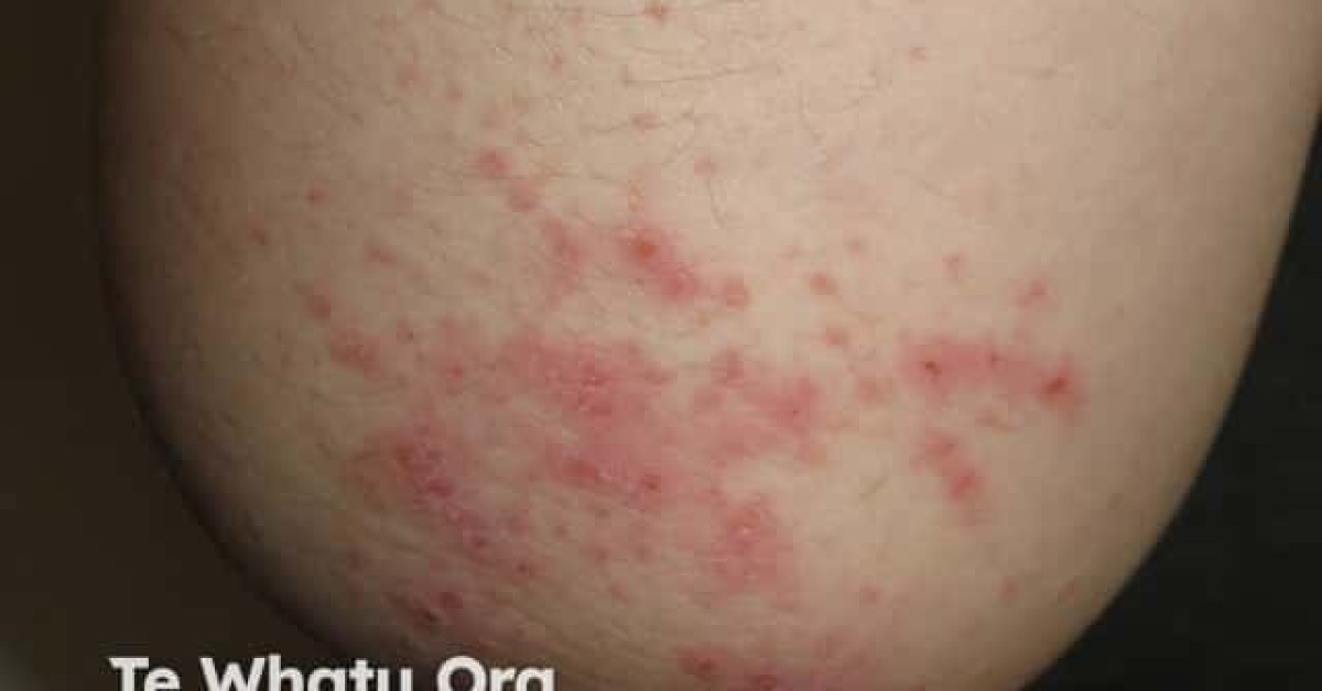 Dermatomyositis of the arm image