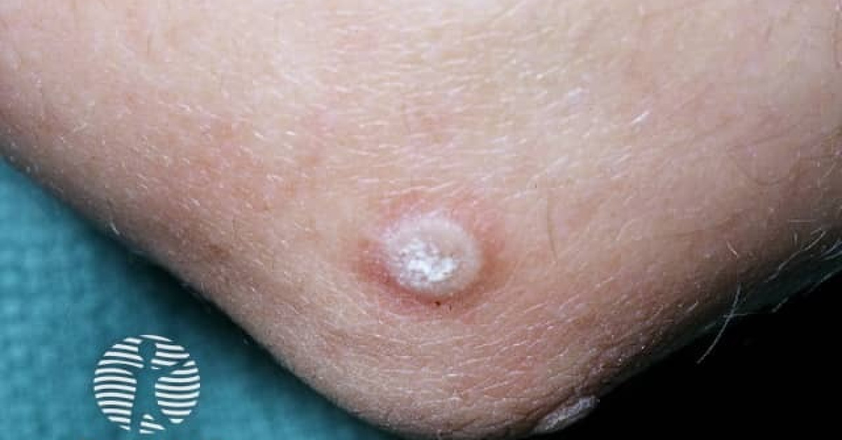 Dermatomyositis of the arm image