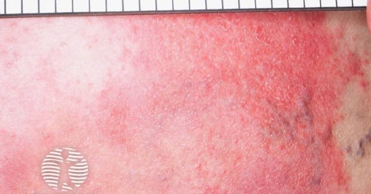 Dermatomyositis of the chest image