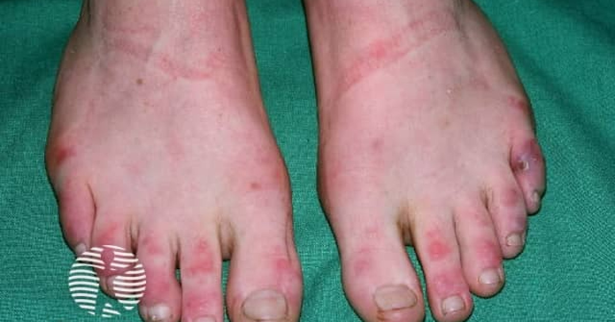 Dermatomyositis of the foot image