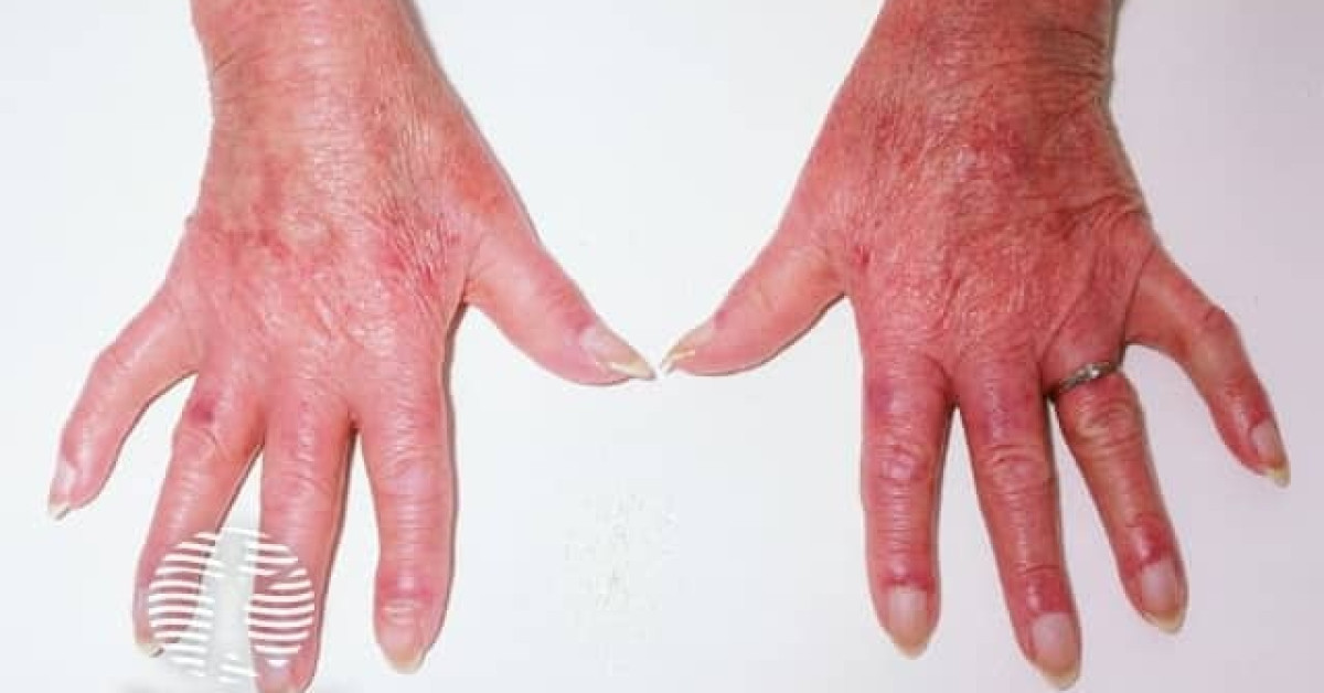 Dermatomyositis of the hand image