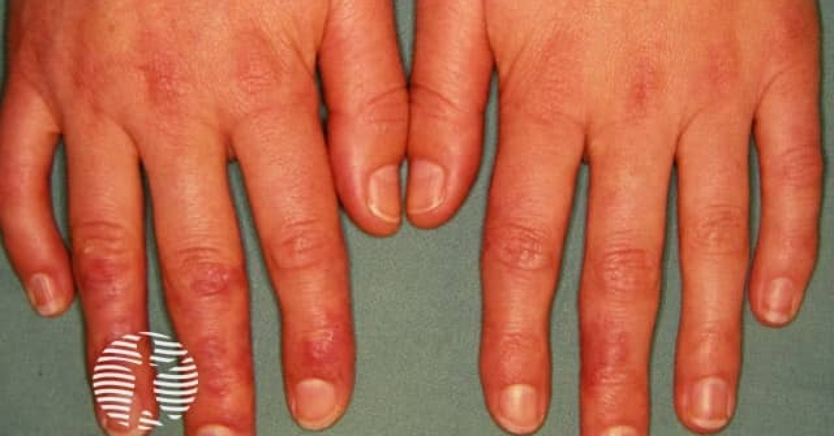 Dermatomyositis of the hand image