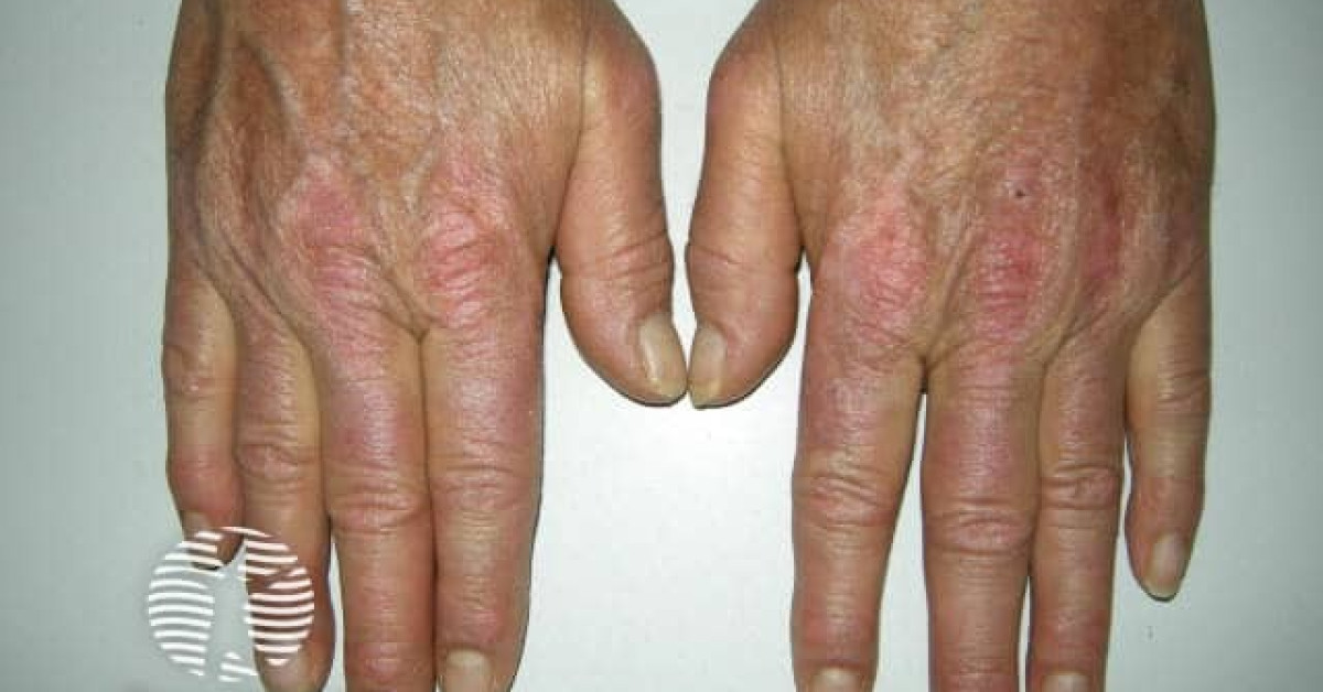 Dermatomyositis of the hand image