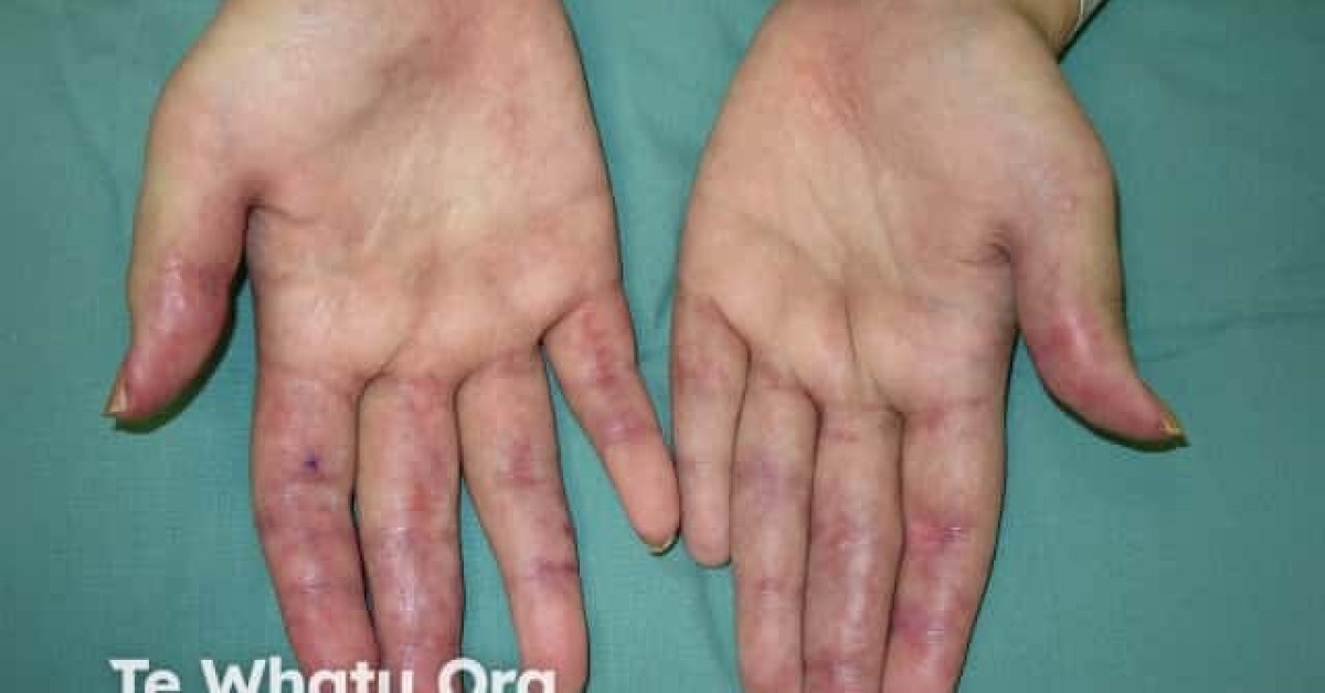 Dermatomyositis of the hand image