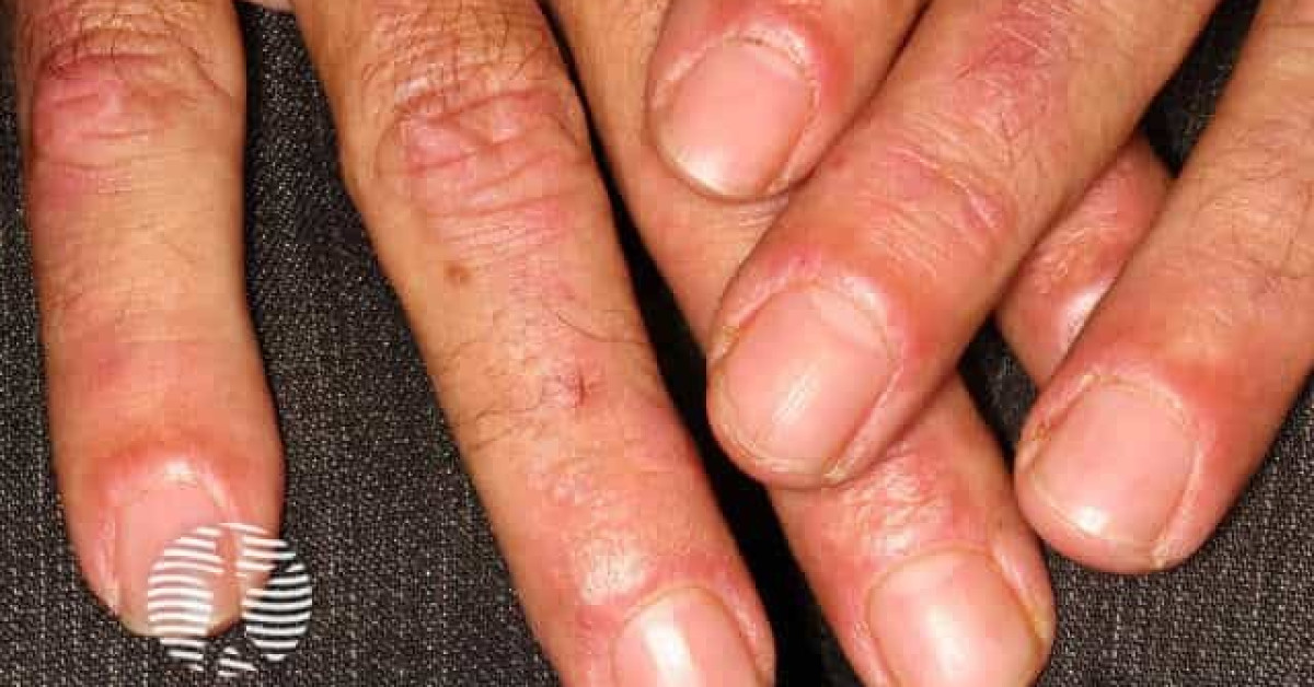 Dermatomyositis of the hand image
