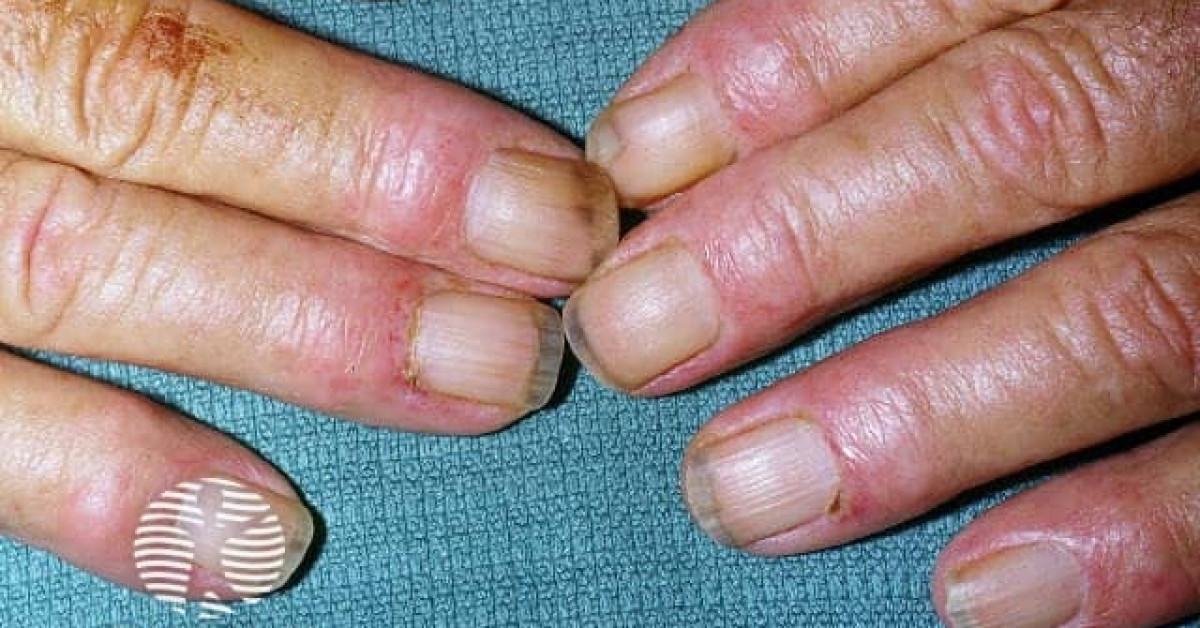 Dermatomyositis of the hand image