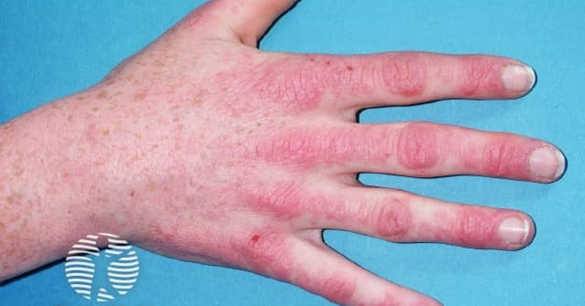 Dermatomyositis of the hand image