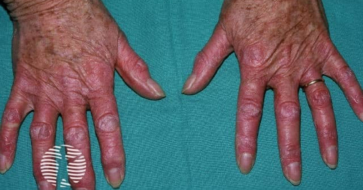 Dermatomyositis of the hand image