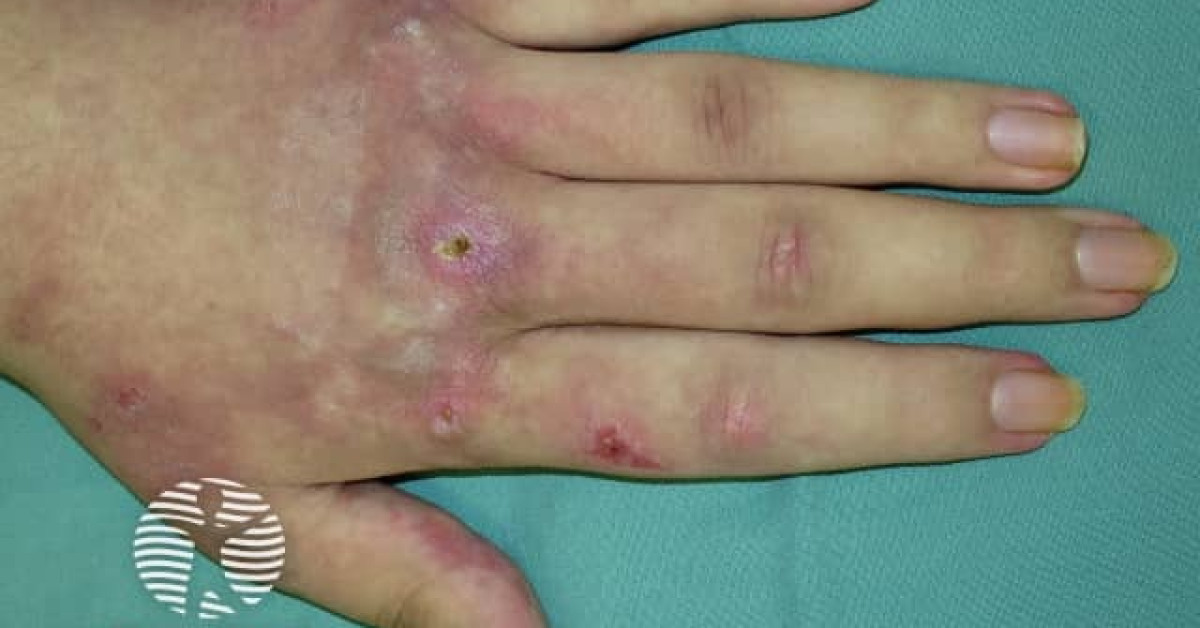 Dermatomyositis of the hand image