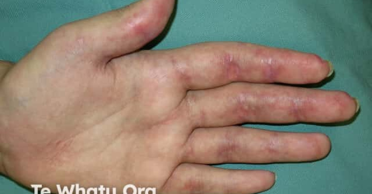 Dermatomyositis of the hand image