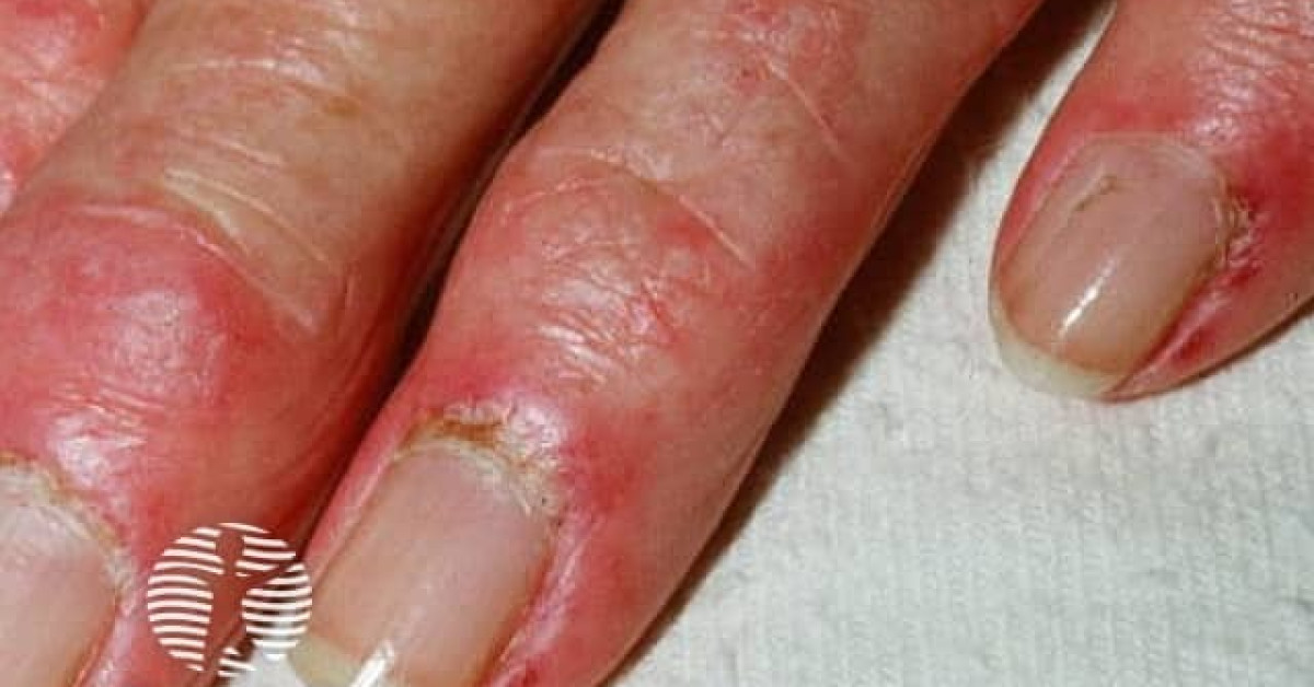 Dermatomyositis of the hand image
