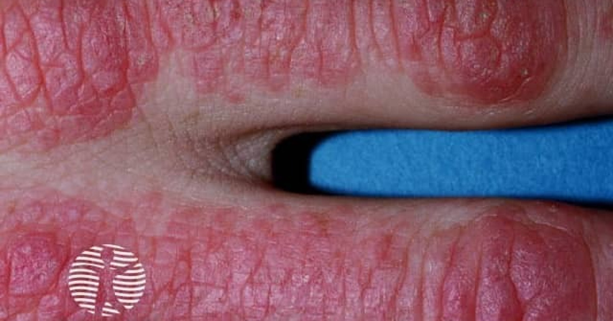 Dermatomyositis of the hand image