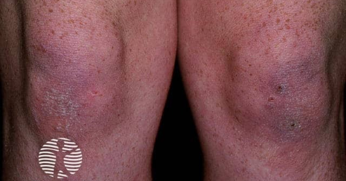Dermatomyositis of the leg image