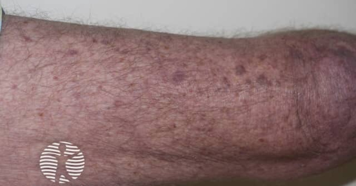 Dermatomyositis of the leg image