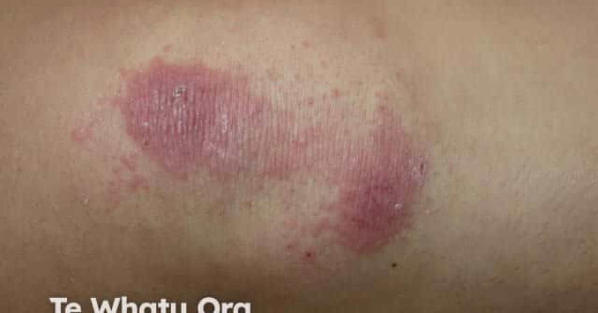 Dermatomyositis of the leg image