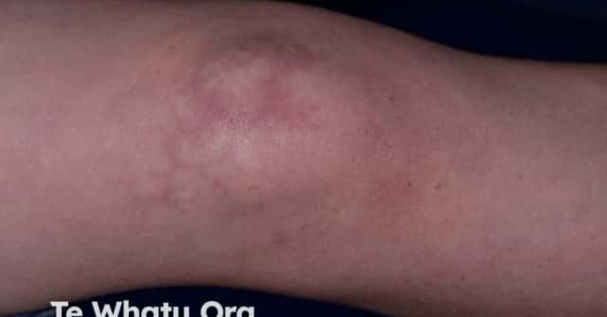 Dermatomyositis of the leg image