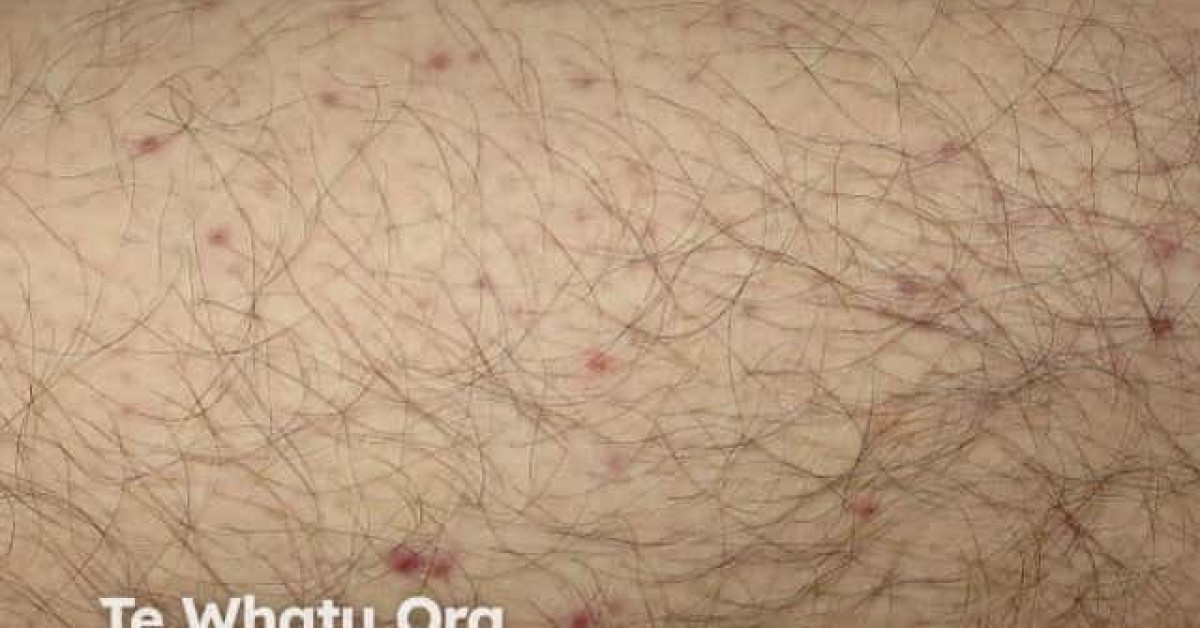 Dermatomyositis of the leg image