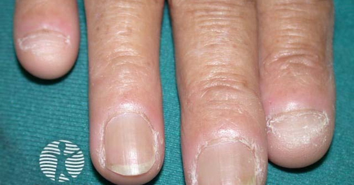 Dermatomyositis of the nail fold image