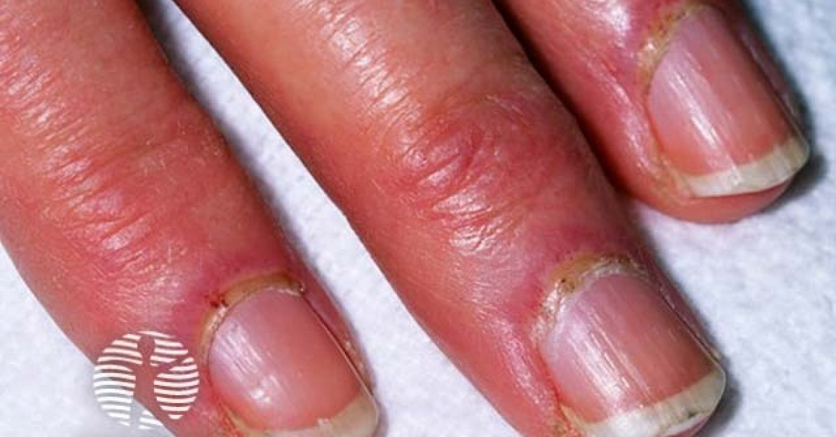 Dermatomyositis of the nail fold image