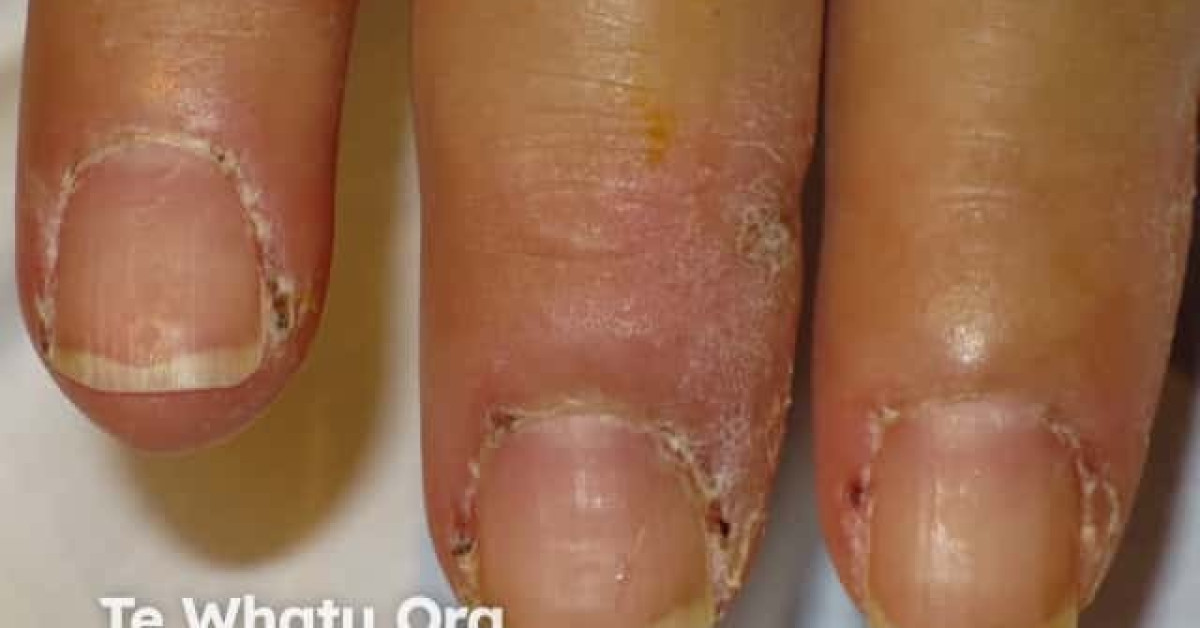 Nail Fold Infarcts. Full Article: Optimal Diagnosis And Management Of