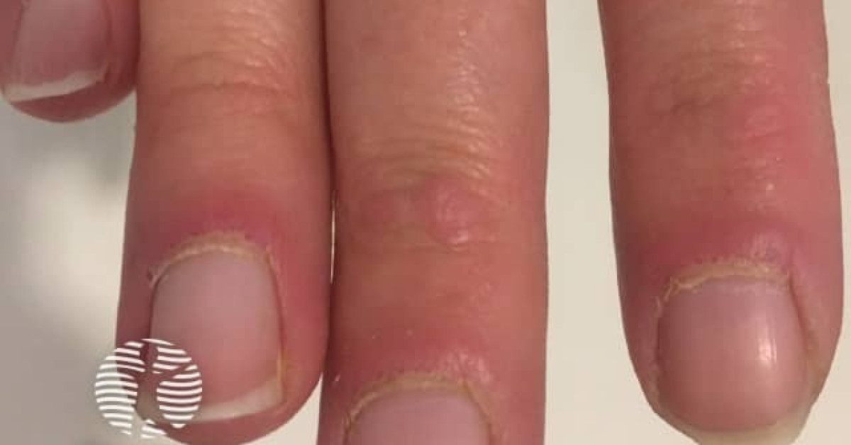 Dermatomyositis of the nailfold image