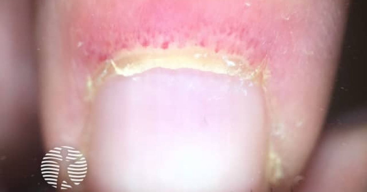 Dermatomyositis of the nailfold image