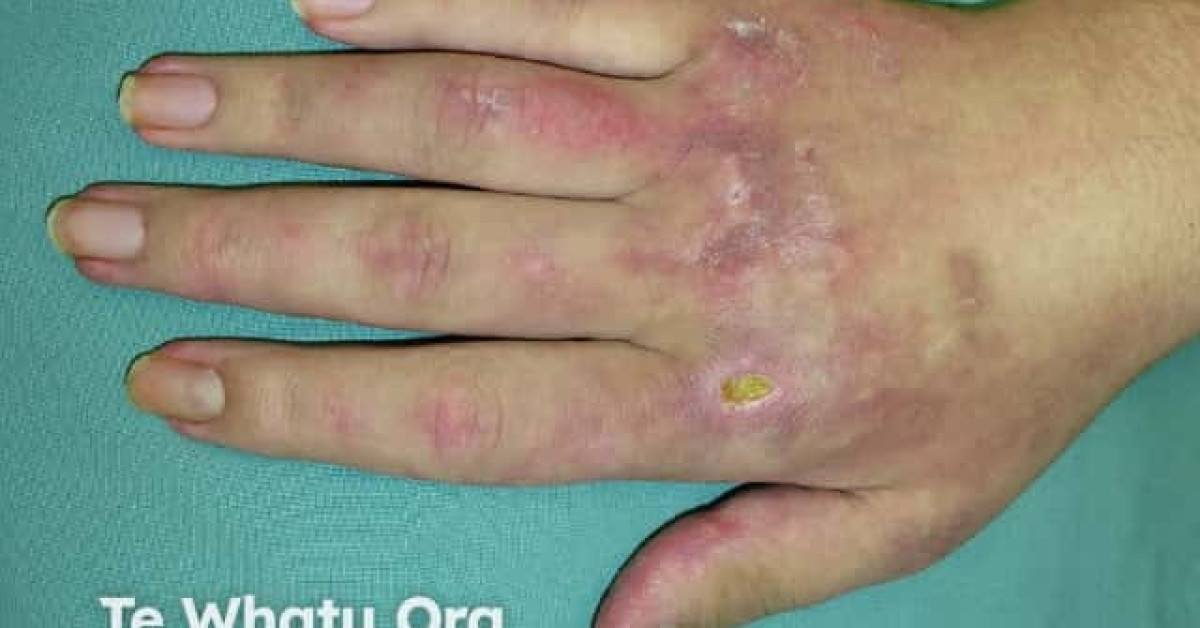 Dermatomyositis - Gottron papules image