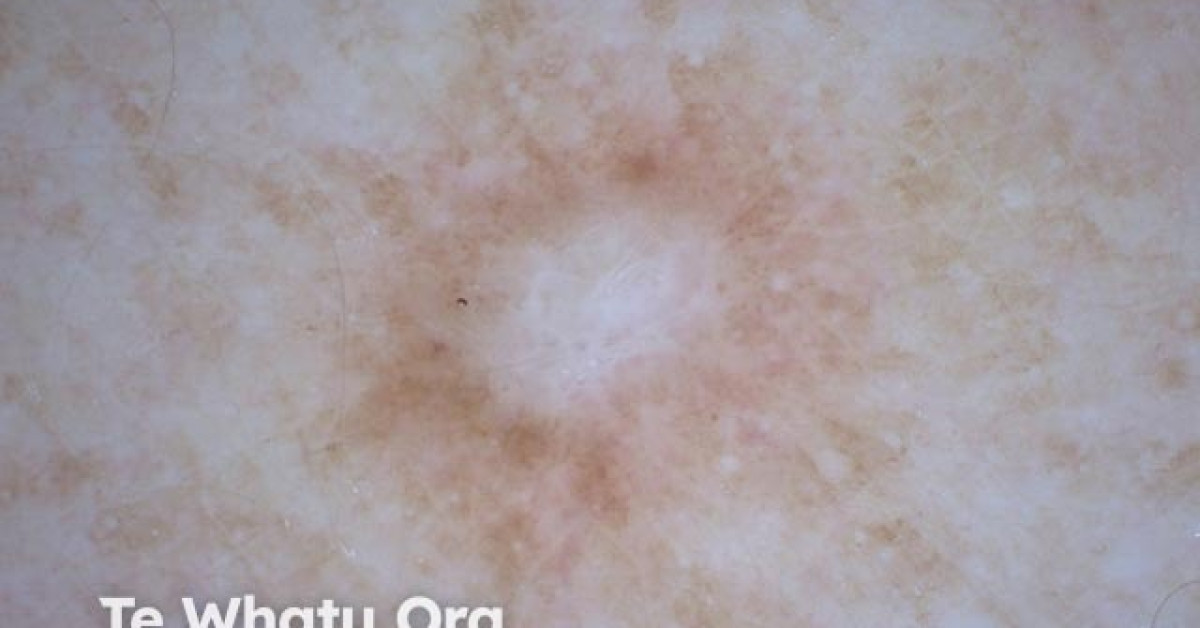 Dermatofibroma, nonpolarised dermoscopy view image