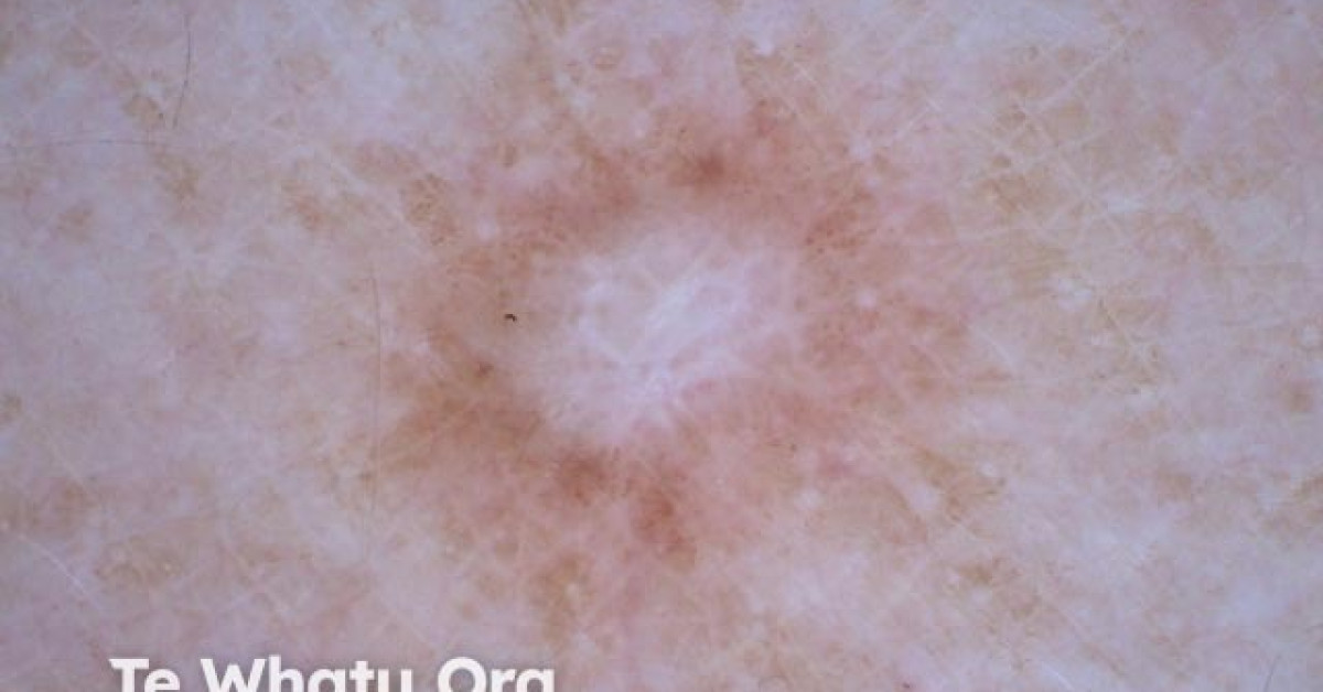 Dermatofibroma, polarised dermoscopy view image