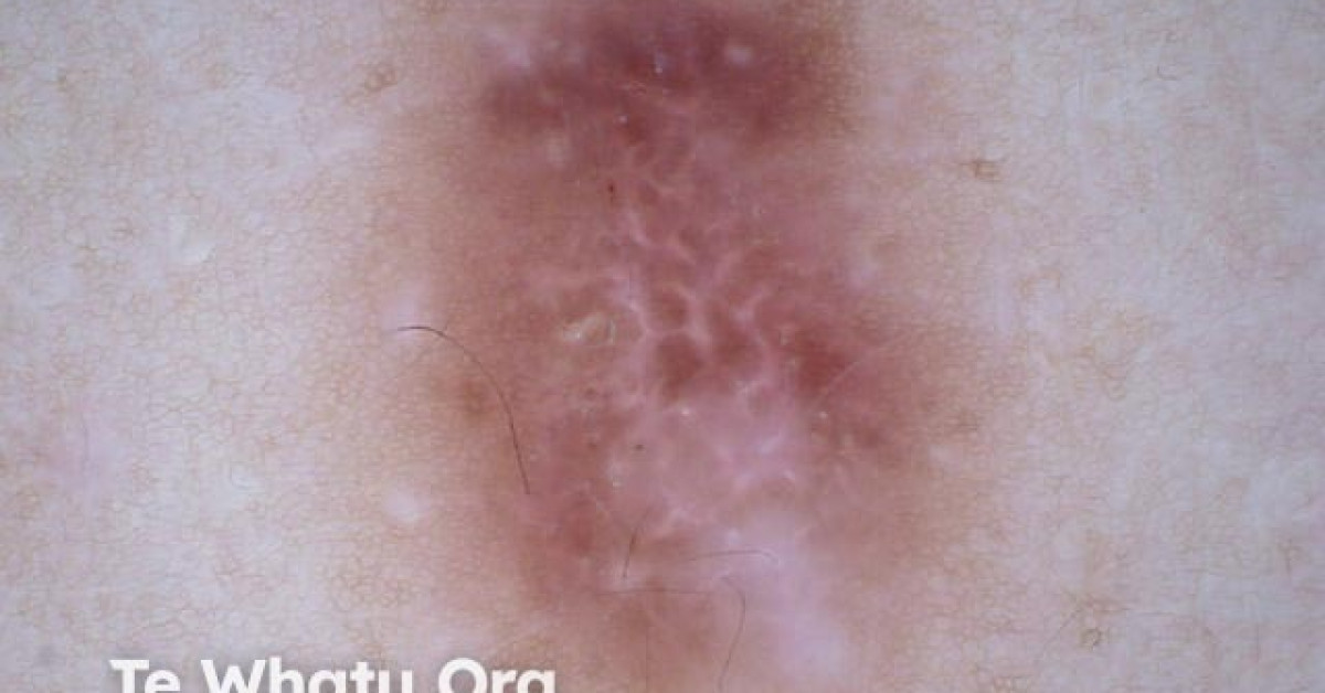 Dermatofibroma, polarised dermoscopy view image