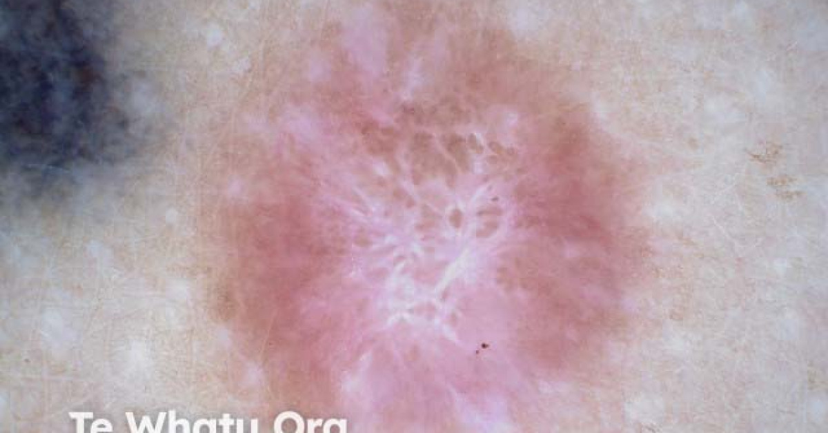 Dermatofibroma, polarised dermoscopy view image